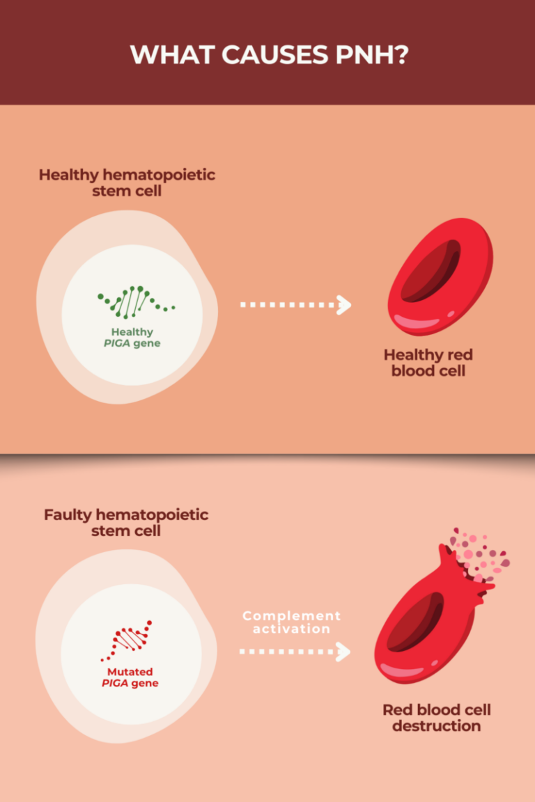 PNH Causes | PNH News